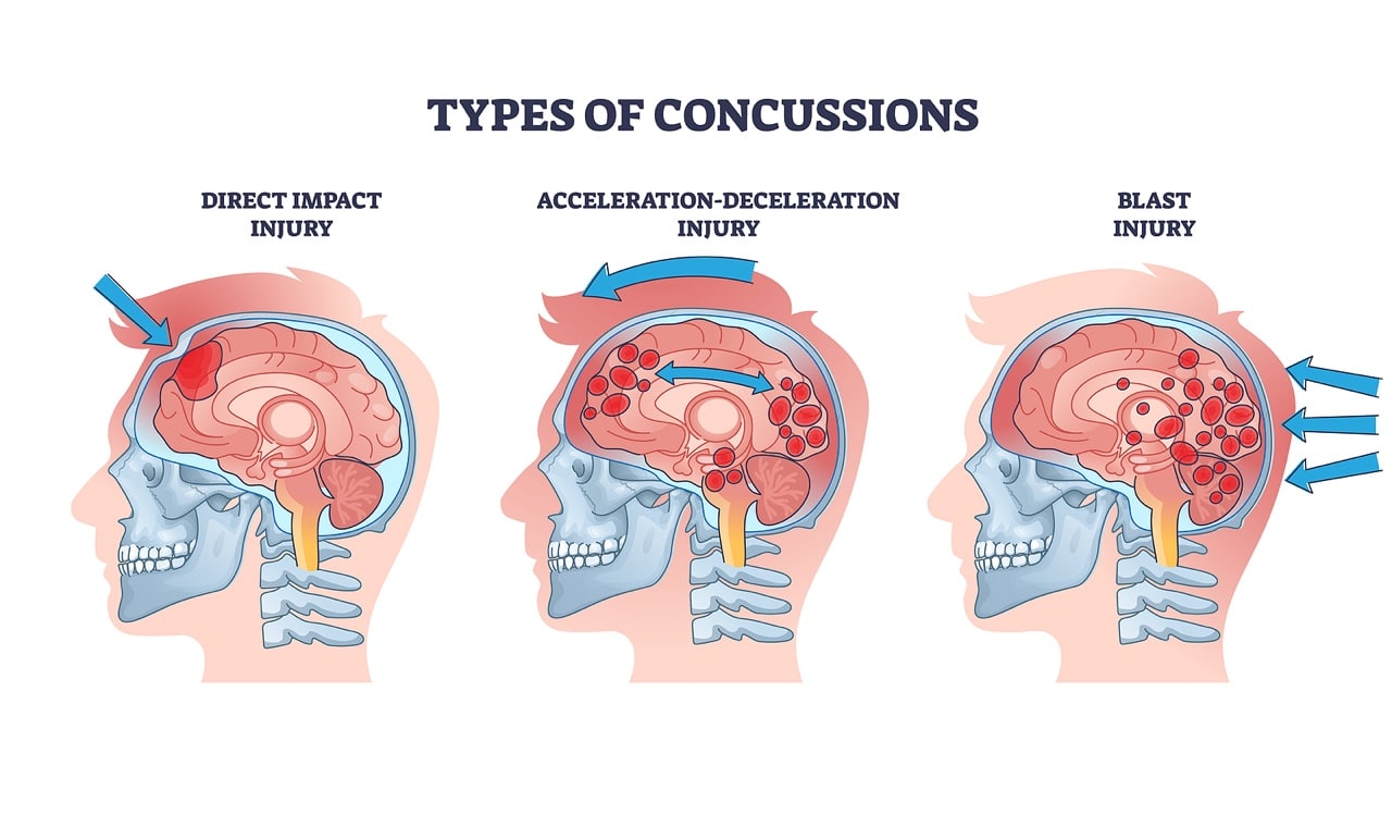 Top 1 Concussion Experts In Miami For Athletes